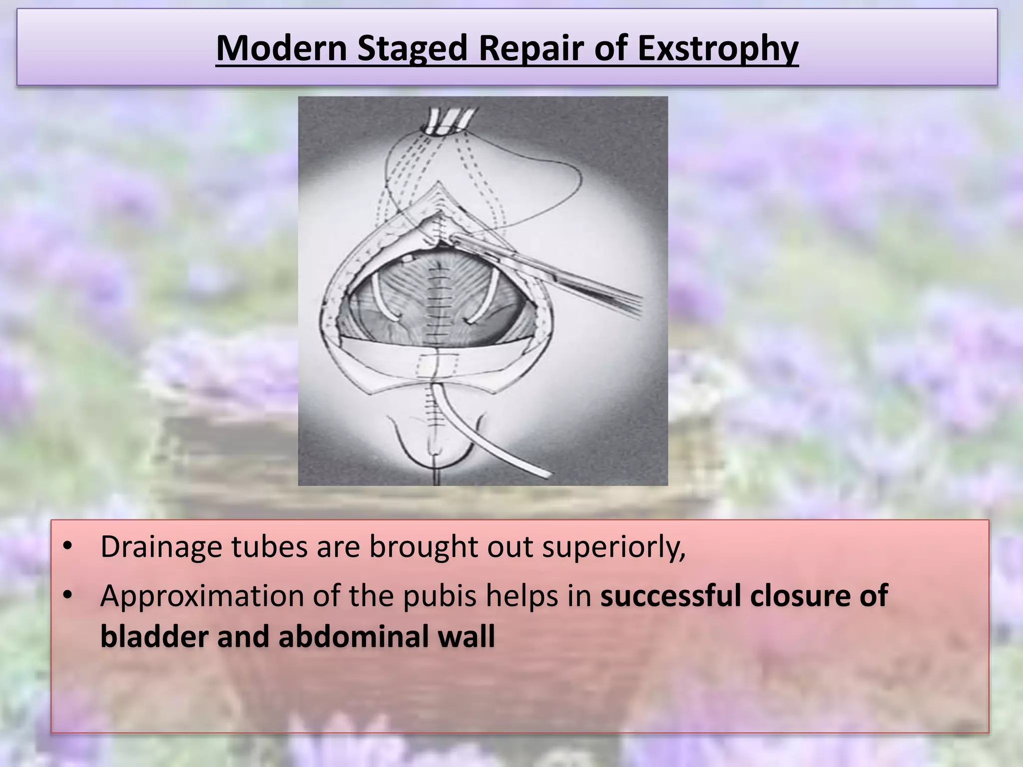 Exstrophy Epispadias Complex MSRE & CPRE | PPTX