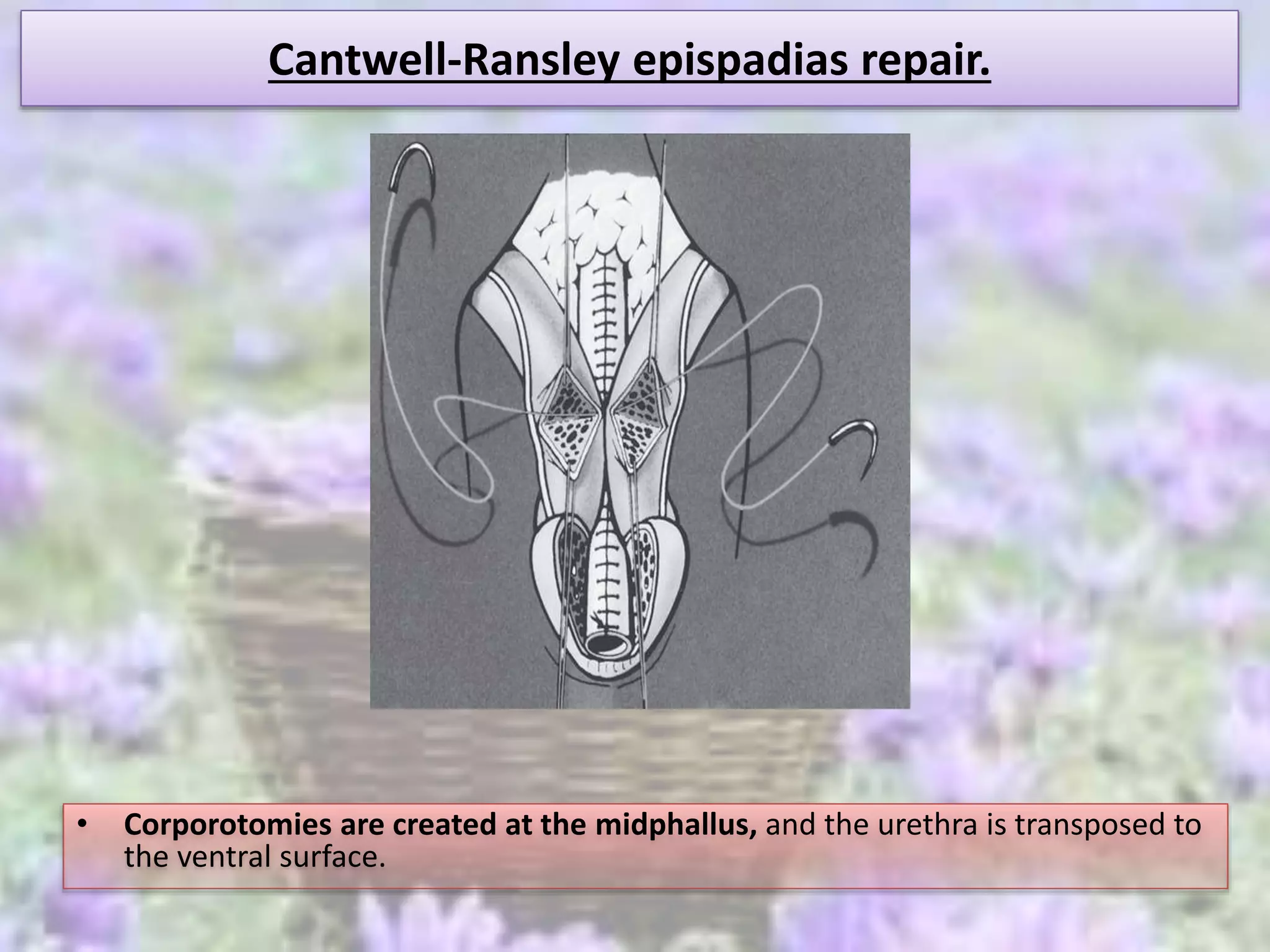 Exstrophy Epispadias Complex MSRE & CPRE | PPTX