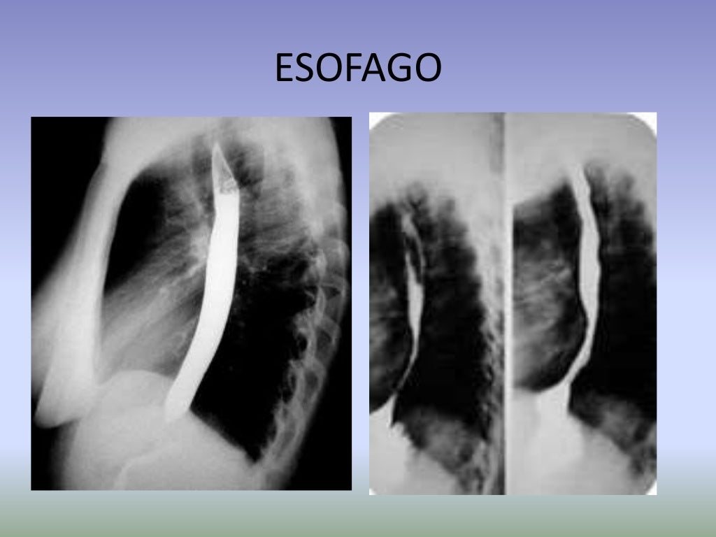 Rx Esofago Hiato Estomago E Duodeno - RETOEDU