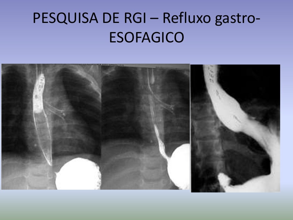 Rx Esofago Hiato Estomago E Duodeno - RETOEDU