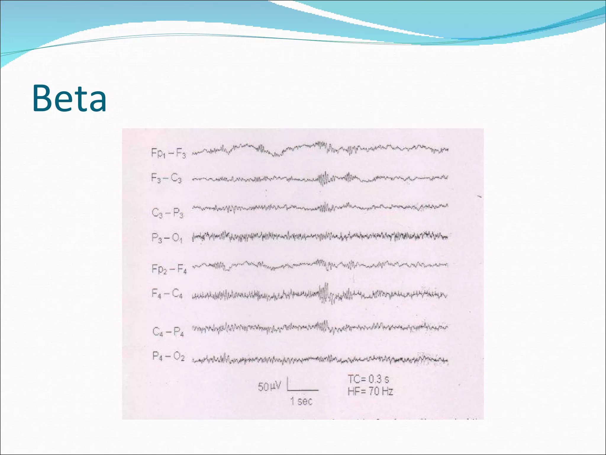 EEG: Basics | PPT