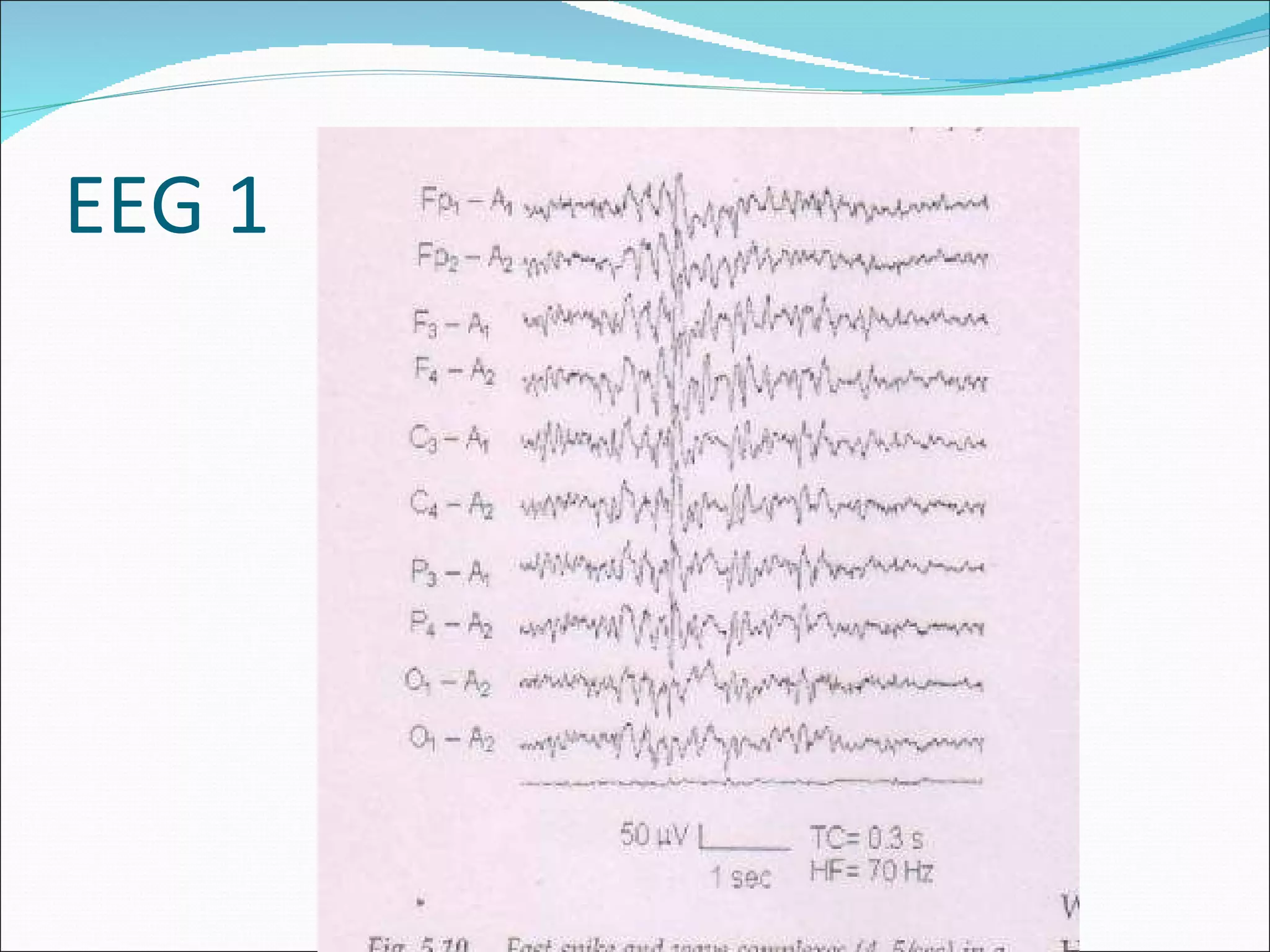 EEG: Basics | PPT