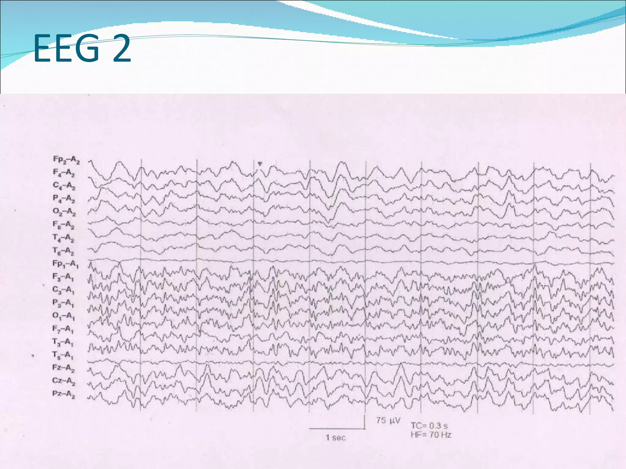 EEG: Basics | PPT