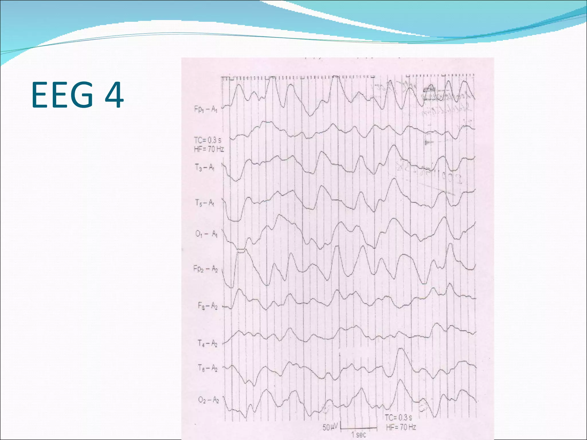 EEG: Basics | PPT