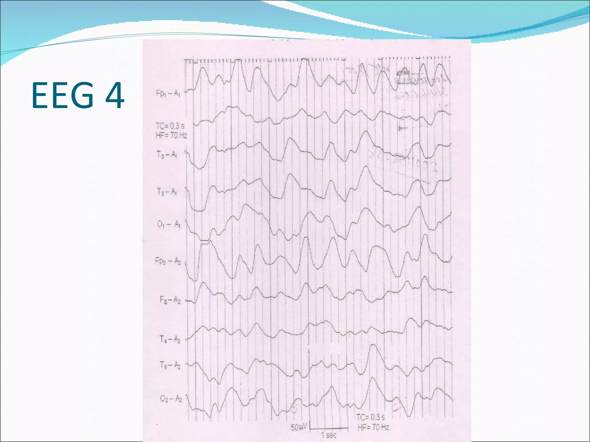 EEG: Basics | PPT