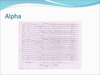 EEG: Basics | PPT