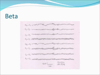 EEG: Basics | PPT