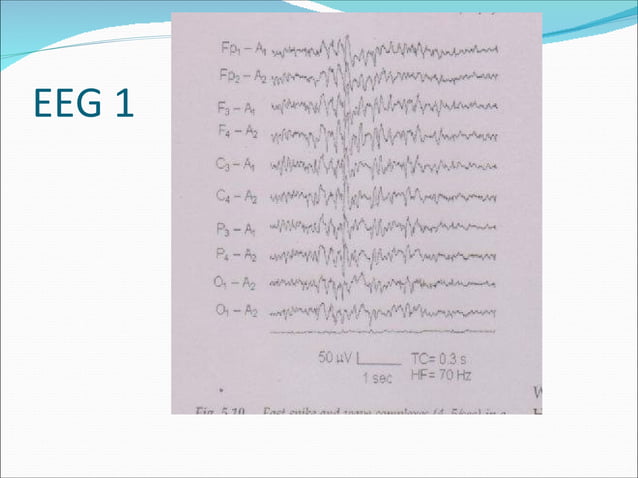 EEG: Basics | PPT