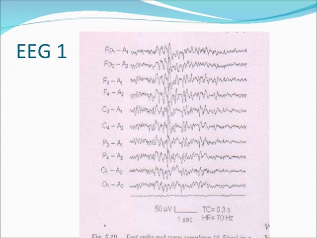 EEG: Basics | PPT