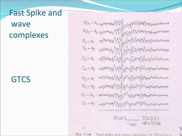 EEG: Basics | PPT