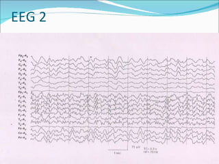 EEG: Basics | PPT
