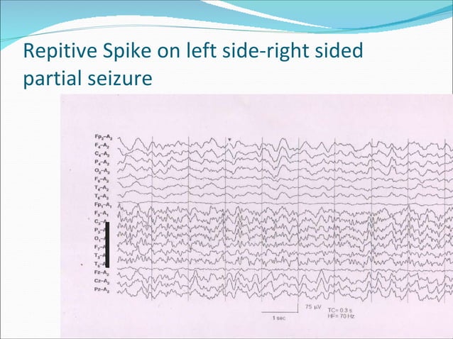 EEG: Basics | PPT