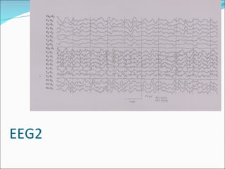EEG: Basics | PPT