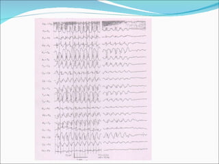 EEG: Basics | PPT