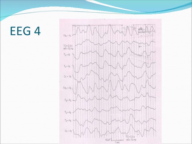 EEG: Basics | PPT