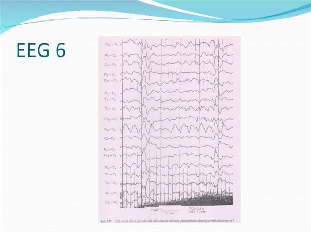 EEG: Basics | PPT