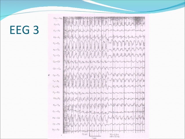 EEG: Basics | PPT