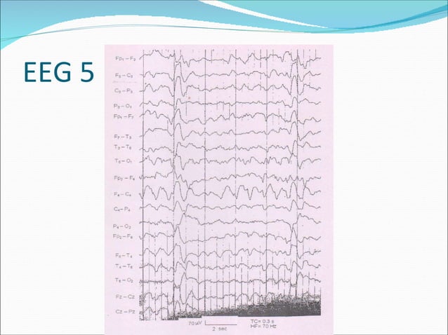 EEG: Basics | PPT