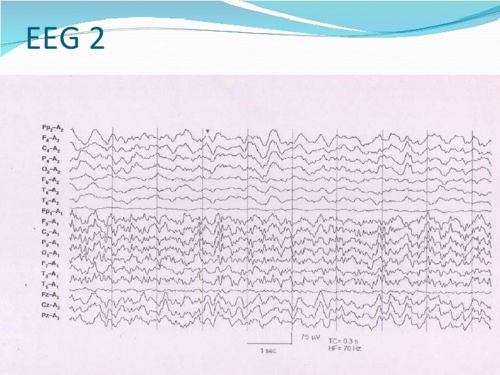 EEG: Basics
