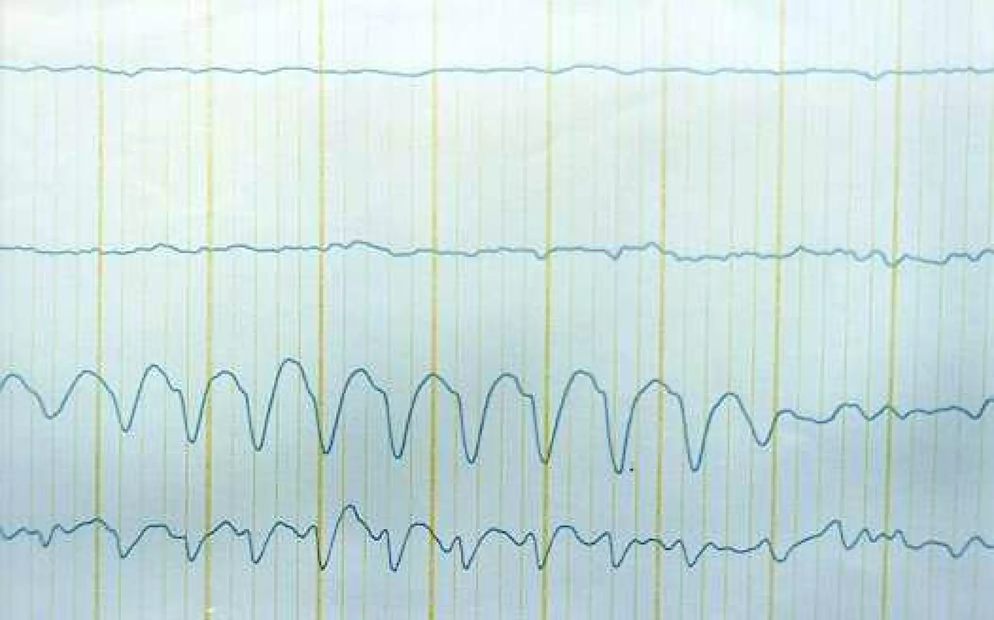 Definition of Some conventional EEG terminologies | PPT