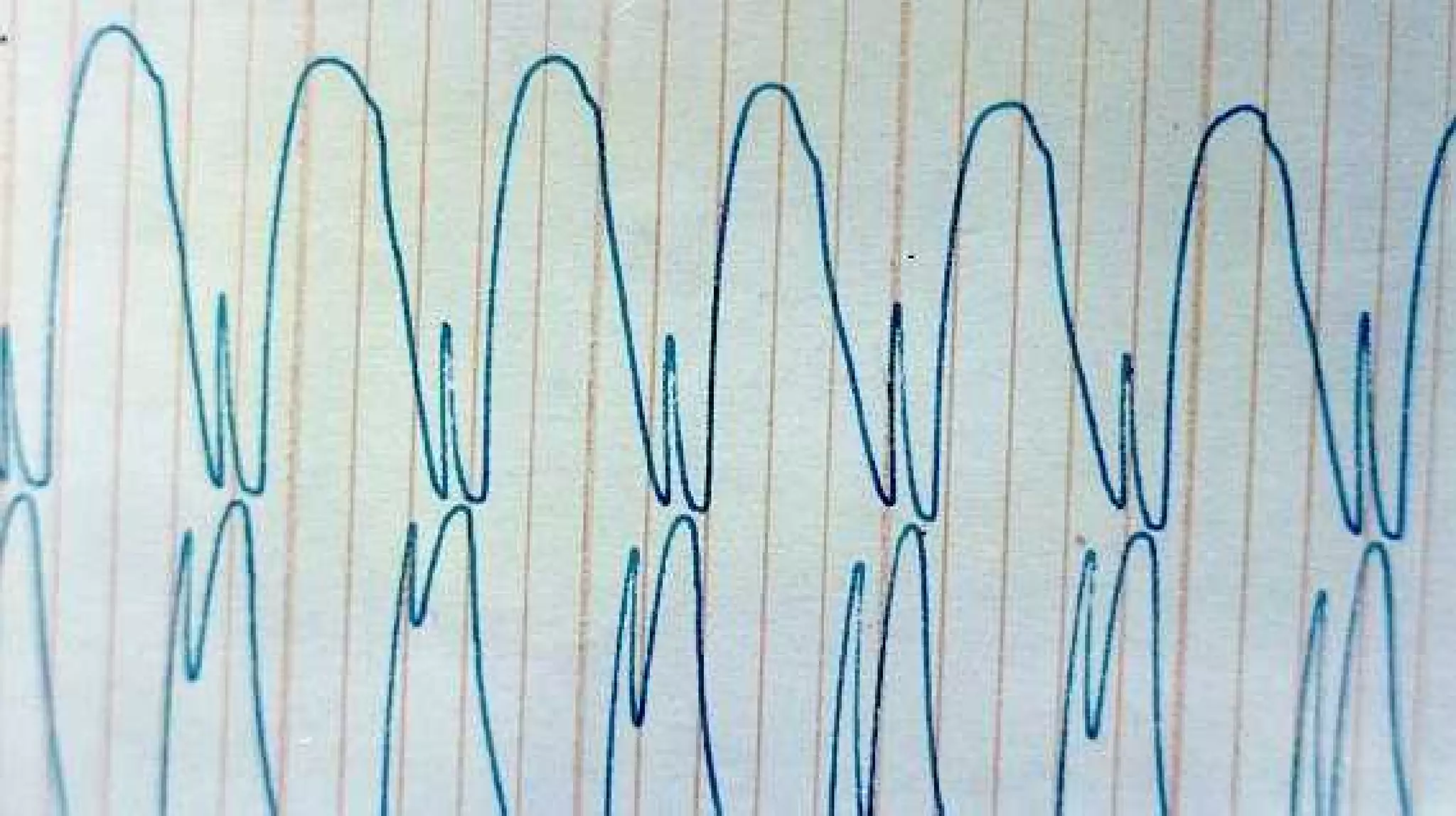 Definition of Some conventional EEG terminologies | PPT