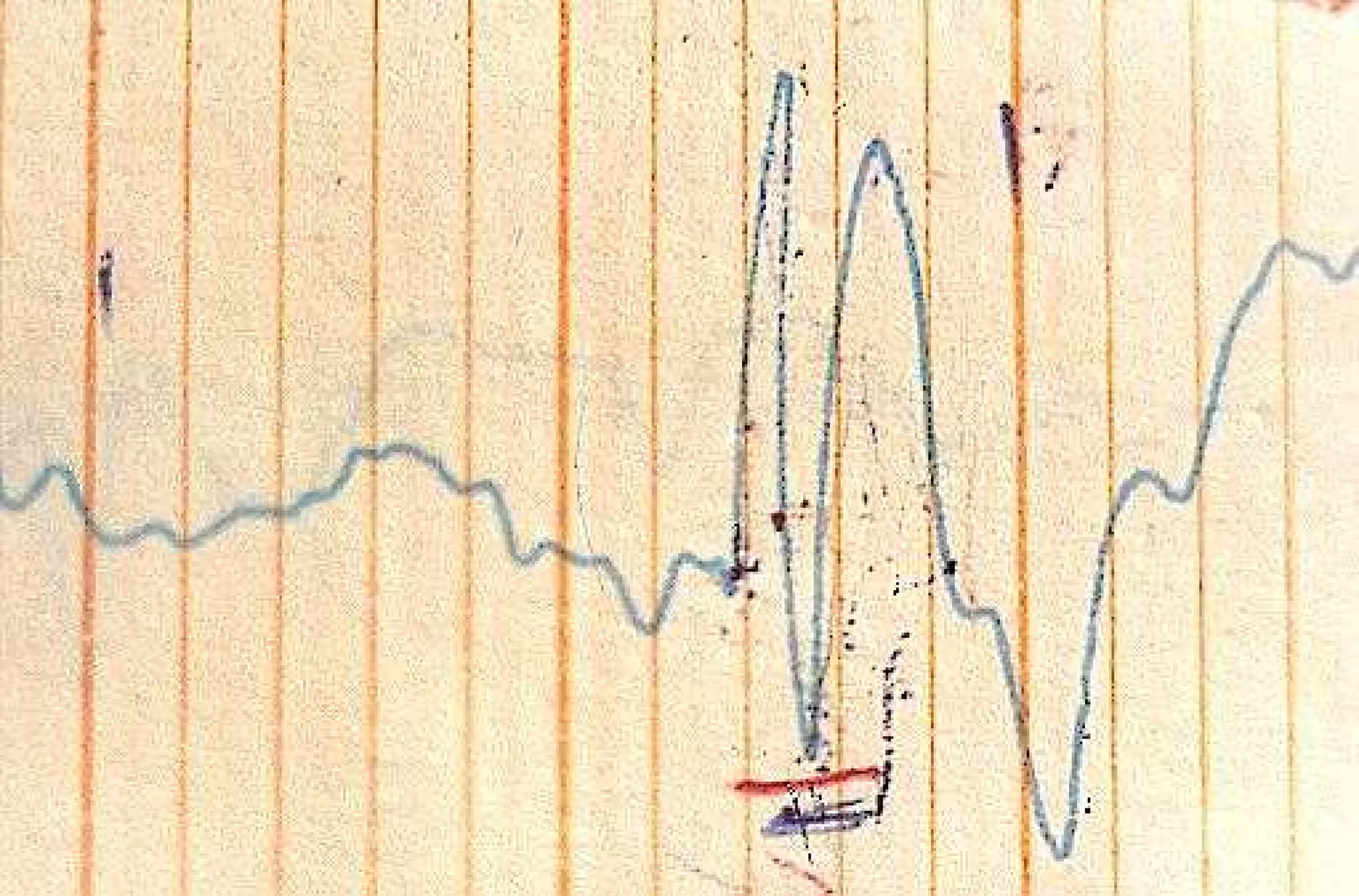 Definition of Some conventional EEG terminologies | PPT