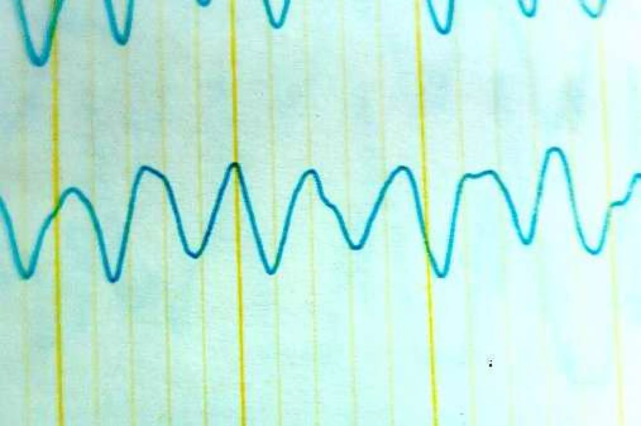 Definition of Some conventional EEG terminologies | PPT