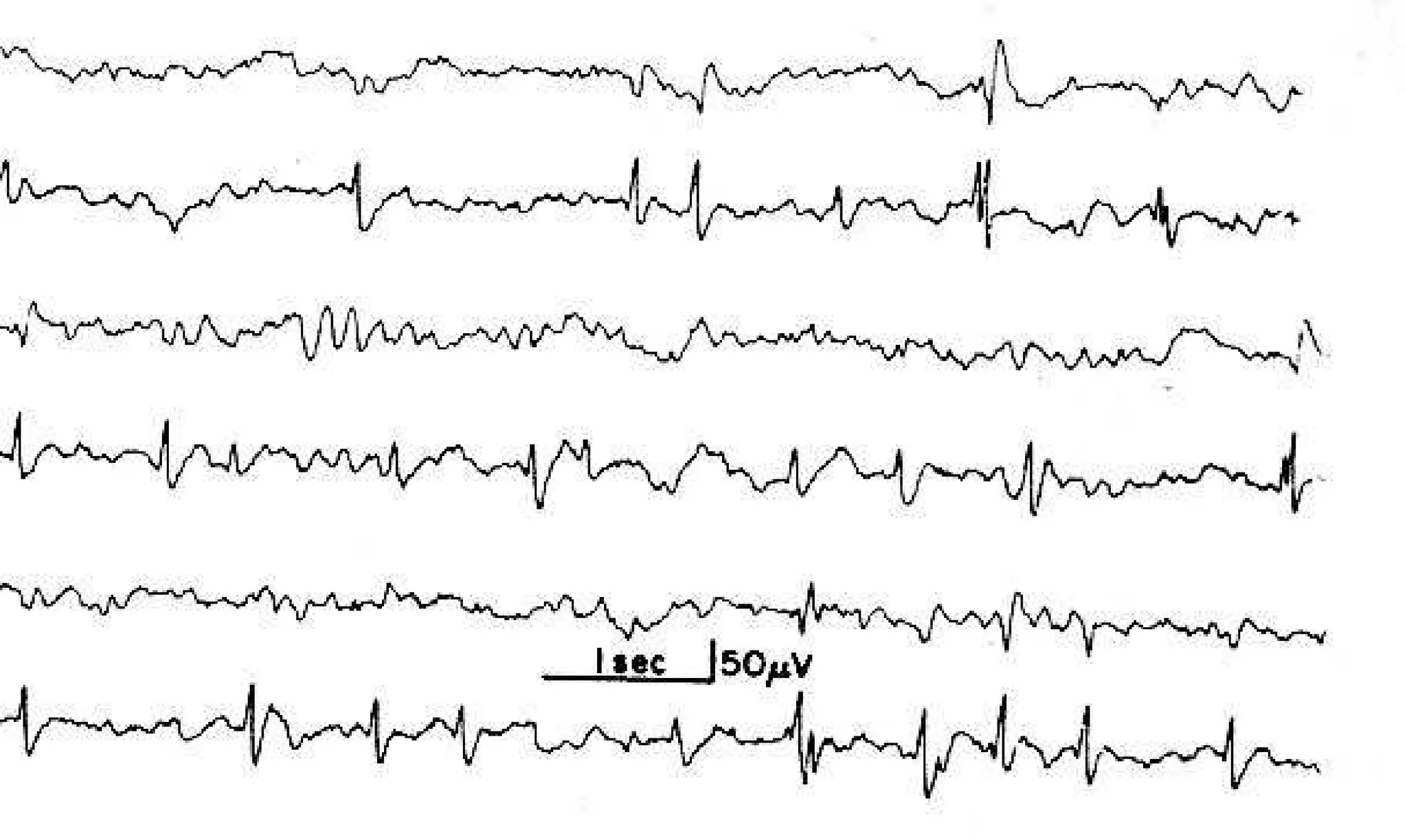 Definition of Some conventional EEG terminologies | PPT