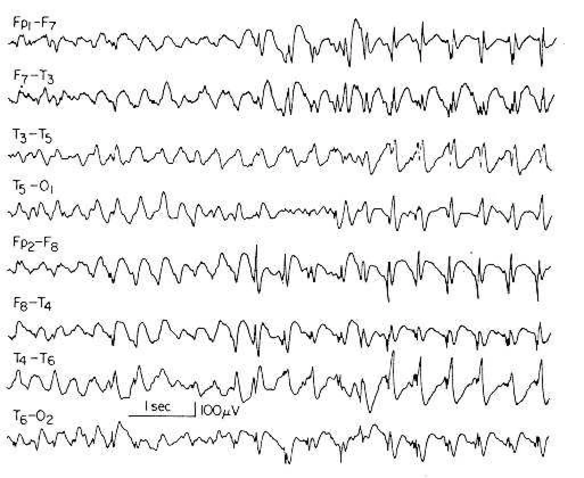 Definition of Some conventional EEG terminologies | PPT