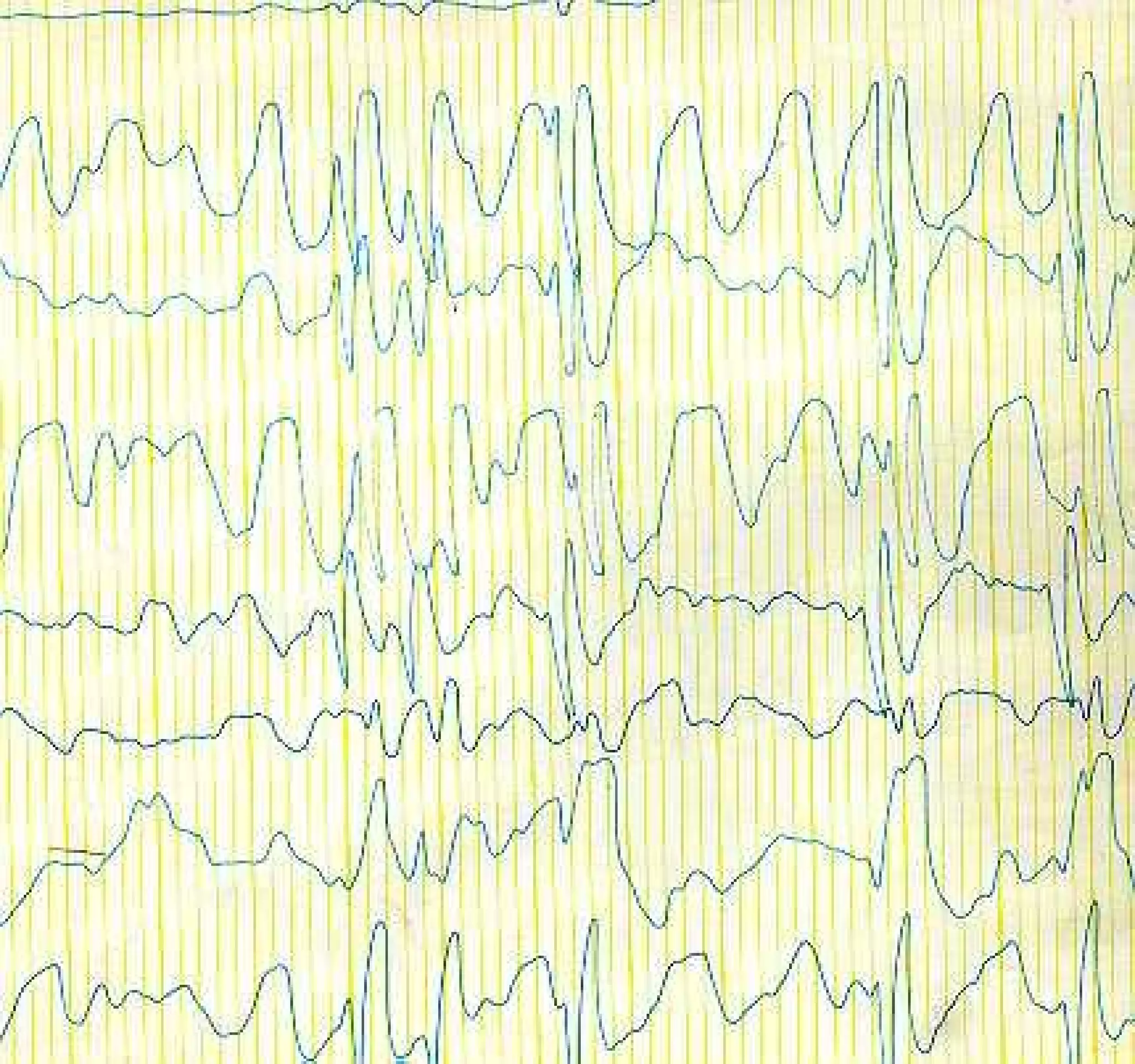 Definition of Some conventional EEG terminologies | PPT