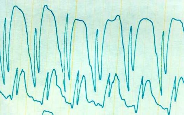 Definition of Some conventional EEG terminologies | PPT