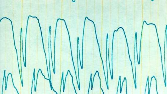 Definition of Some conventional EEG terminologies | PPT