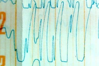 Definition of Some conventional EEG terminologies | PPT