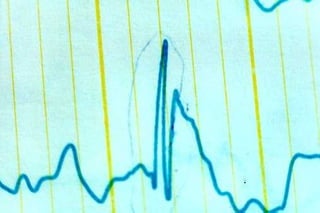 Definition of Some conventional EEG terminologies | PPT