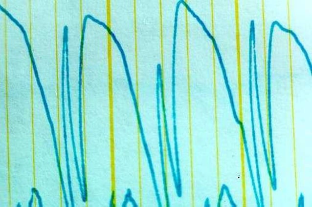 Definition of Some conventional EEG terminologies | PPT