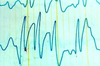 Definition of Some conventional EEG terminologies | PPT