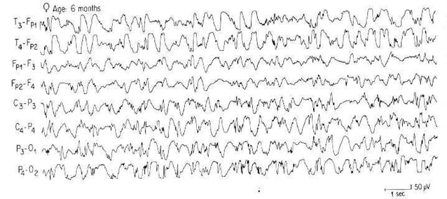Definition of Some conventional EEG terminologies | PPT