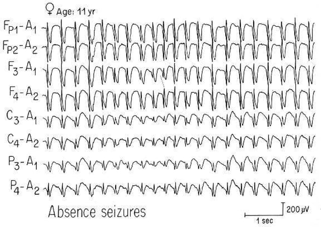Definition of Some conventional EEG terminologies | PPT