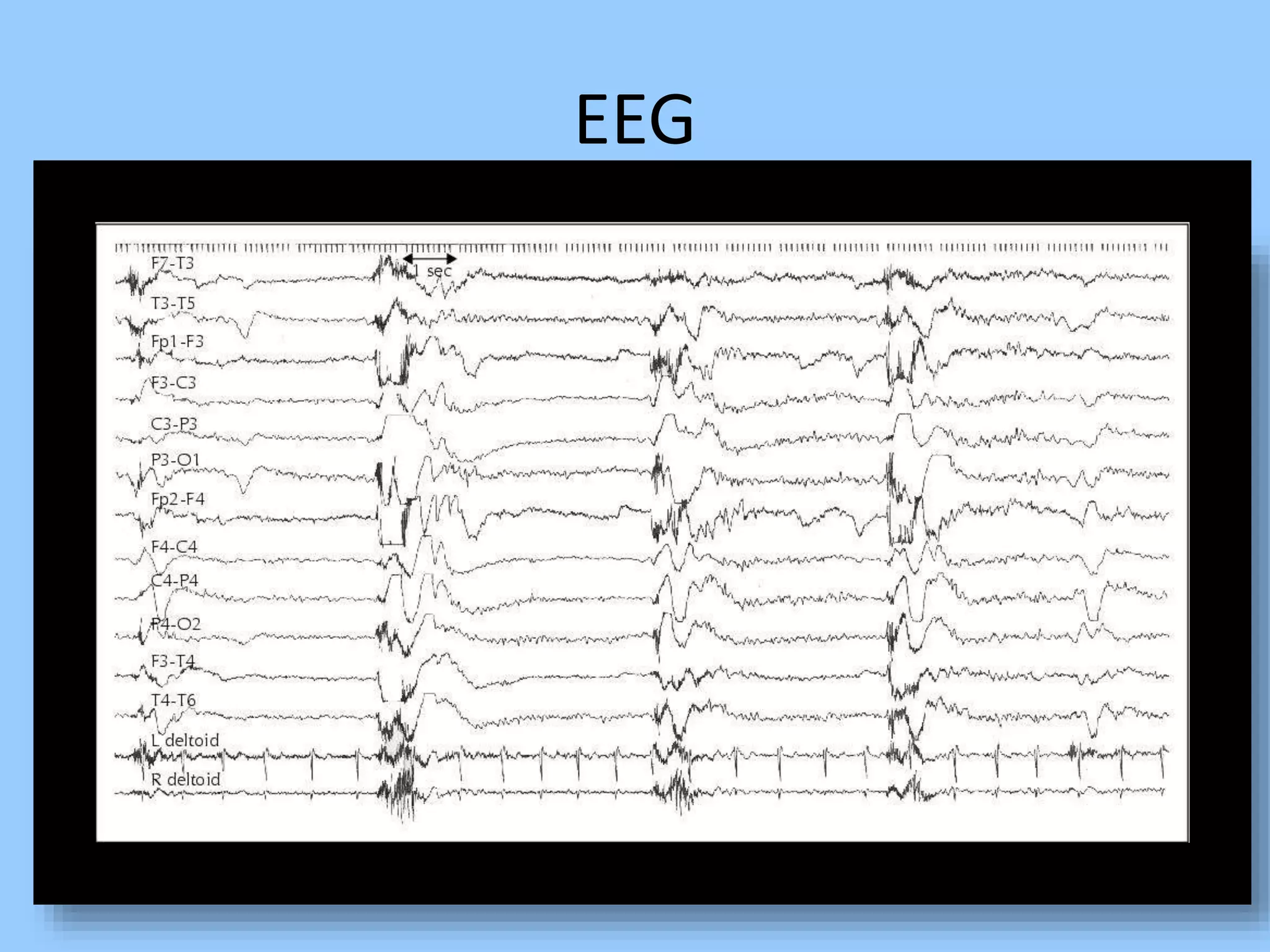 Eeg in pediatric (DNB PEDIATRIC) | PPTX