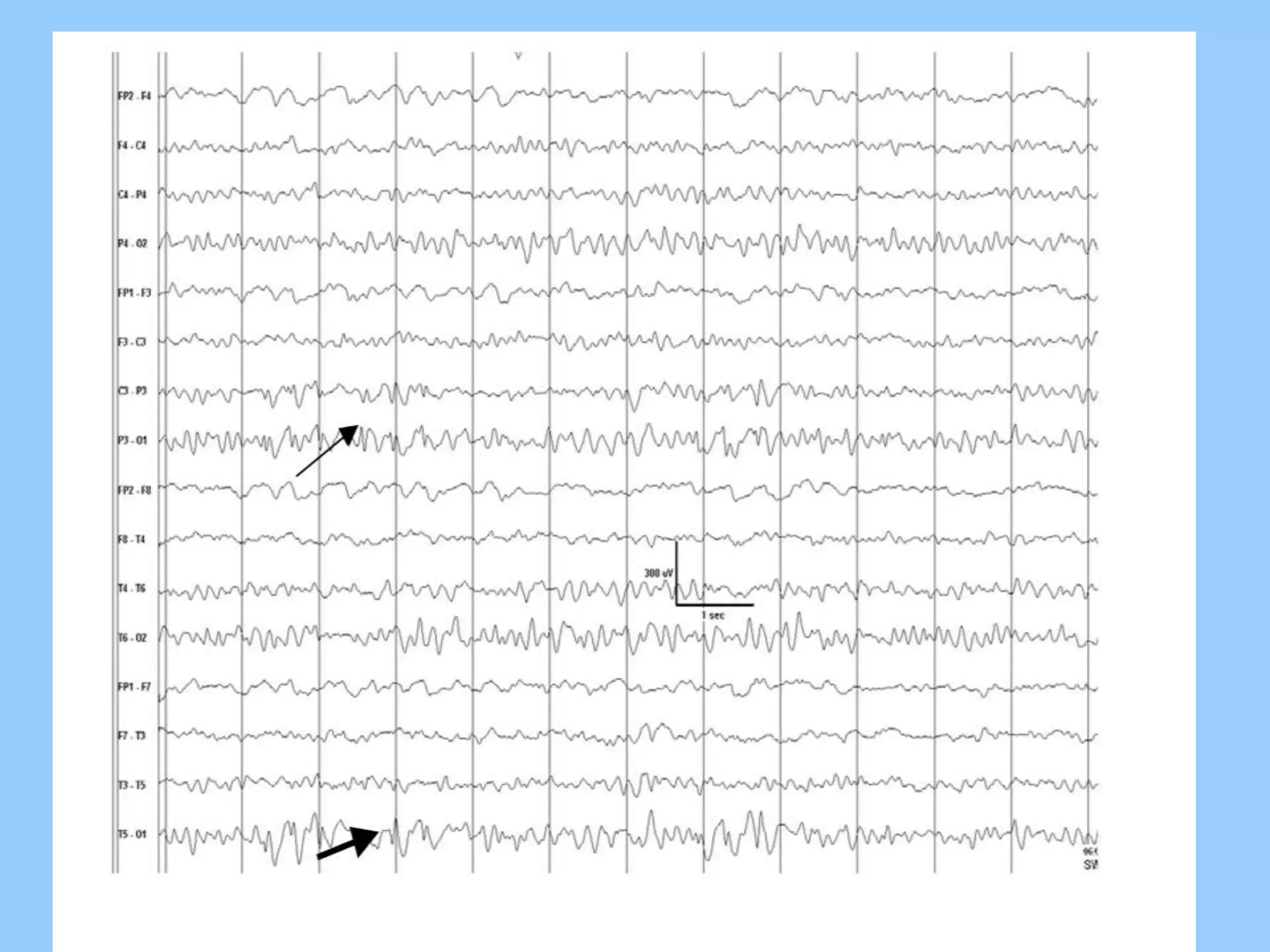 Eeg in pediatric (DNB PEDIATRIC) | PPTX