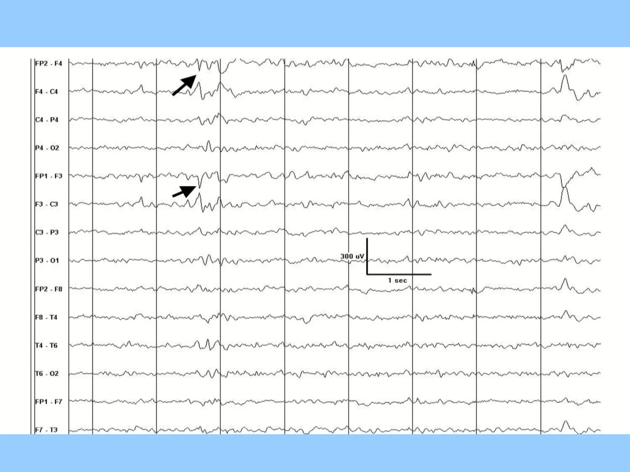 Eeg in pediatric (DNB PEDIATRIC) | PPTX