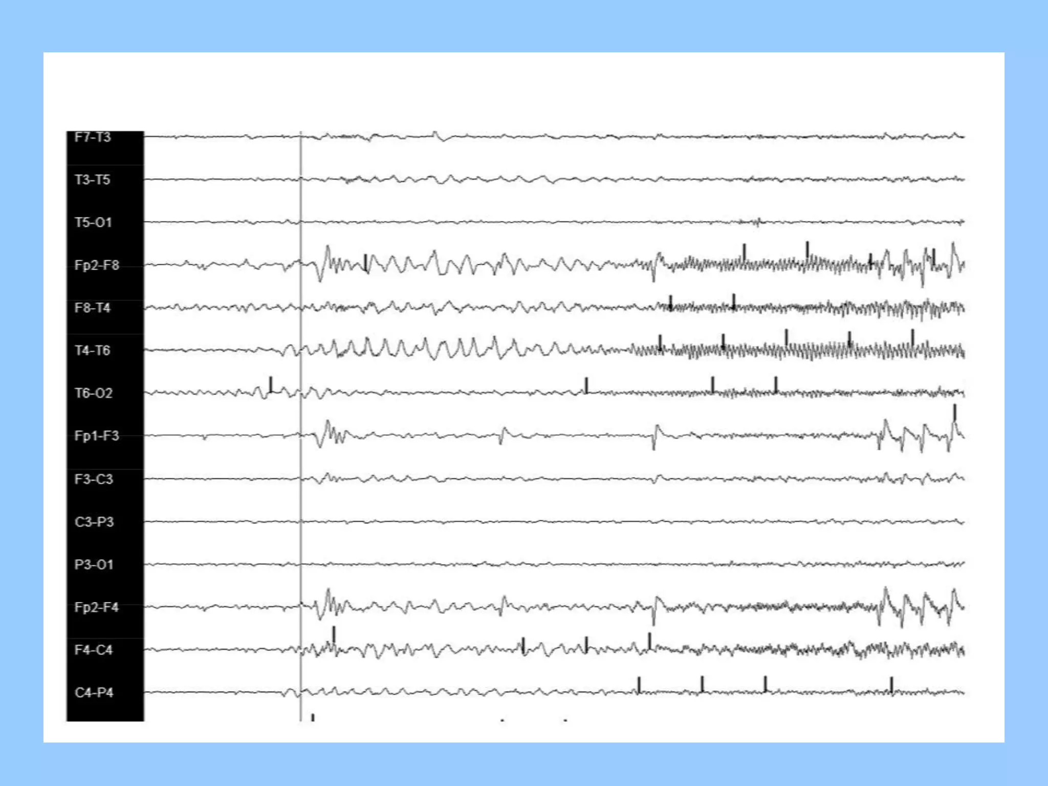 Eeg in pediatric (DNB PEDIATRIC) | PPTX