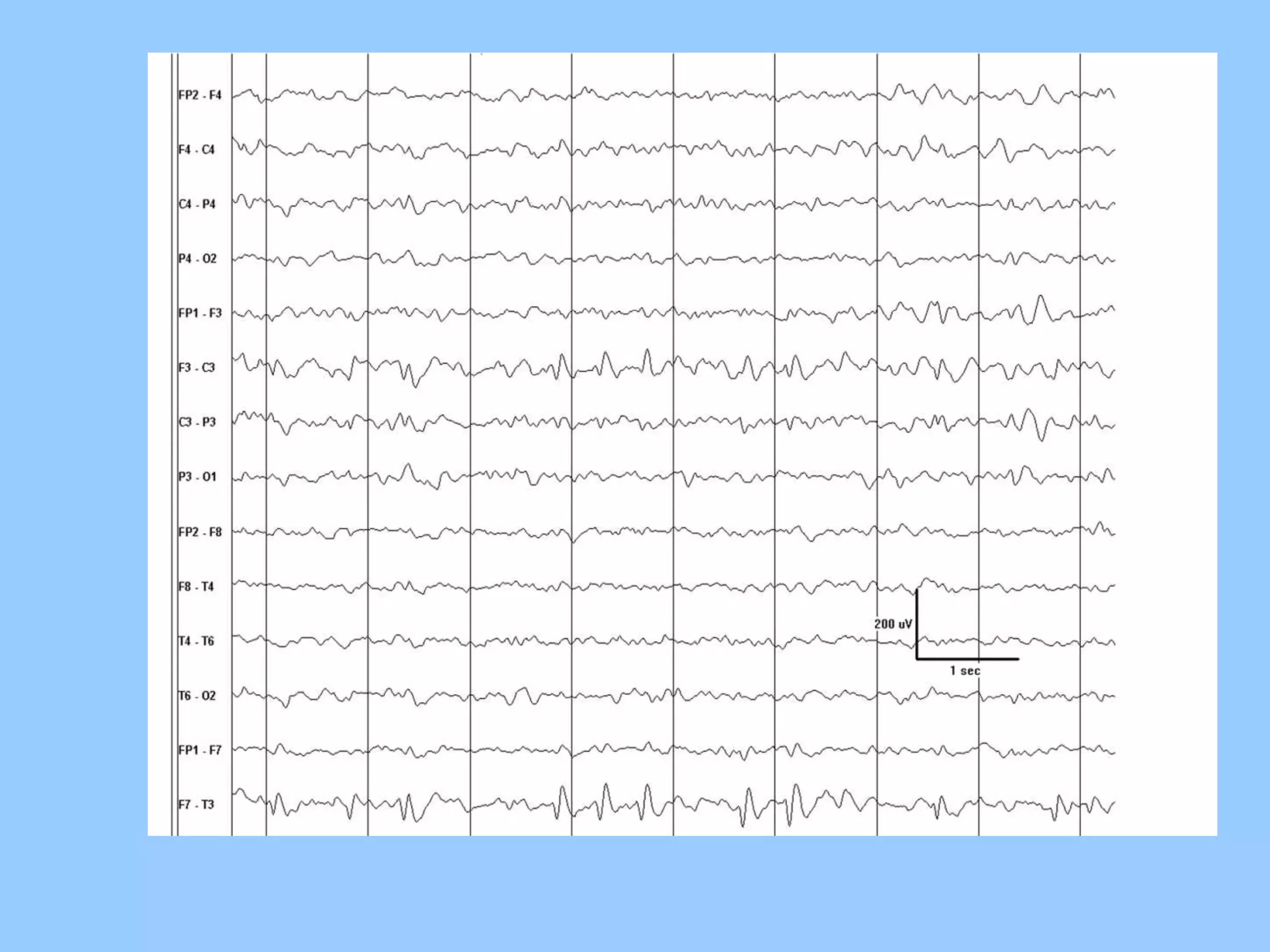 Eeg in pediatric (DNB PEDIATRIC) | PPTX