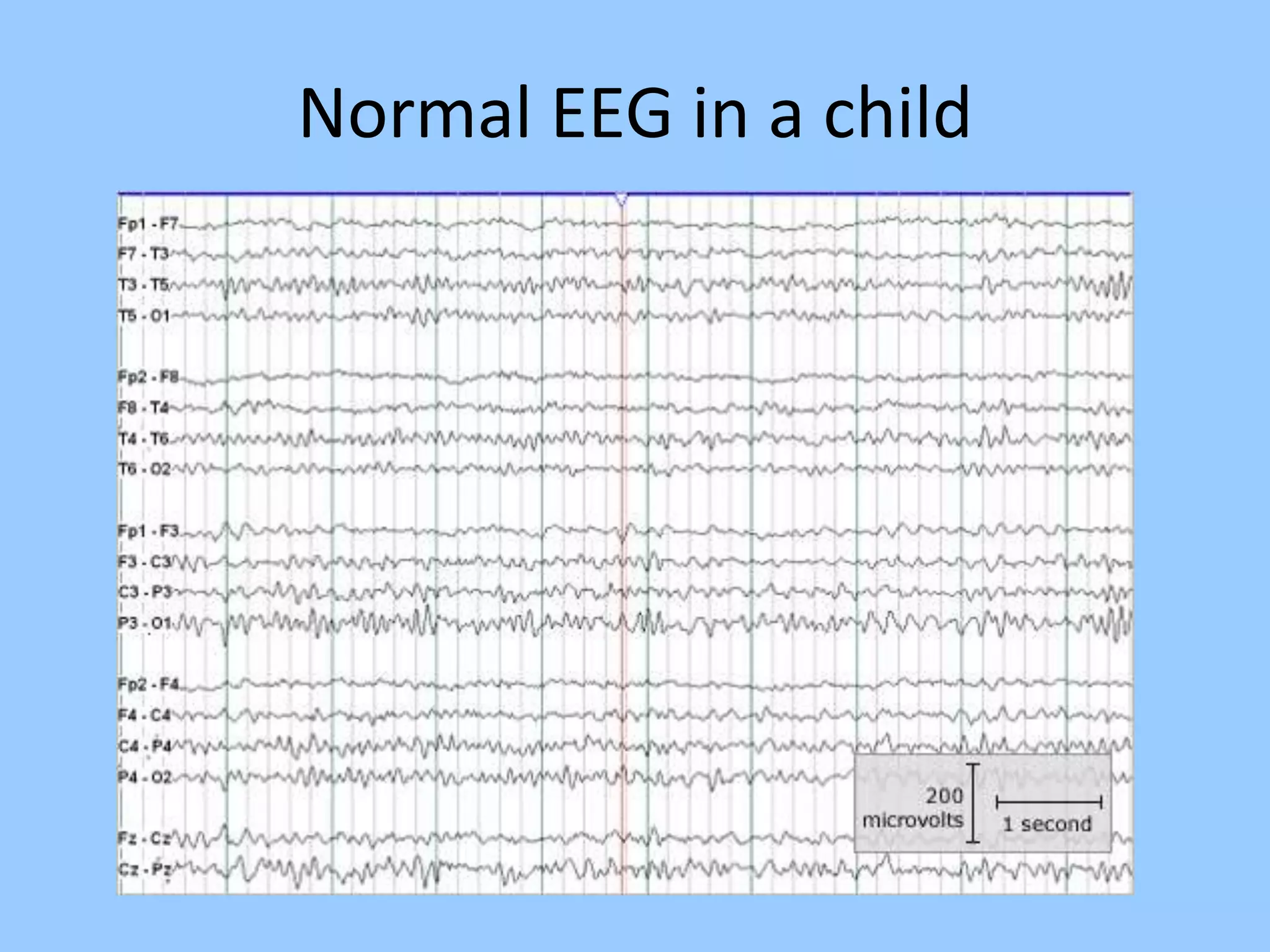Eeg in pediatric (DNB PEDIATRIC) | PPTX