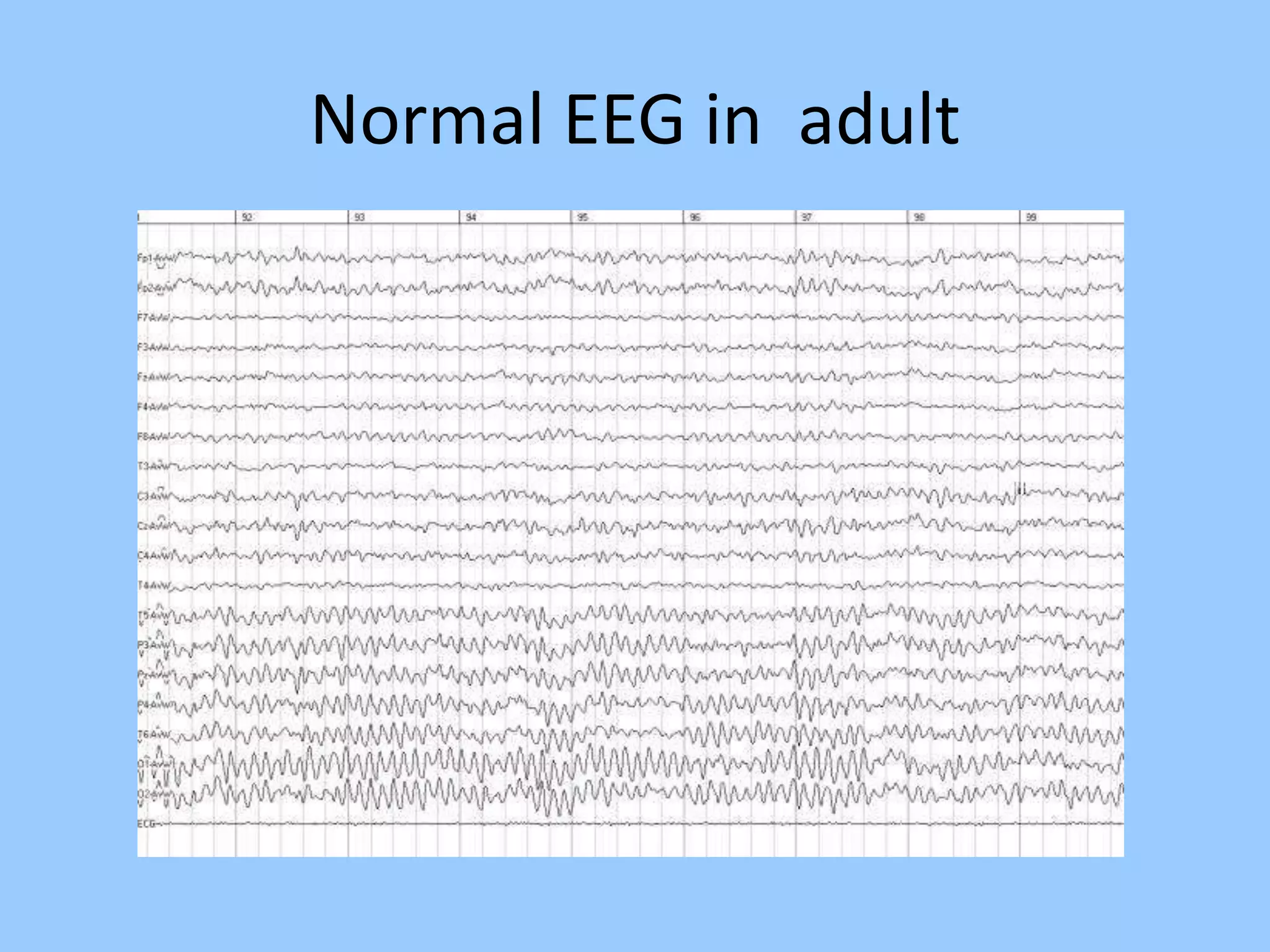 Eeg in pediatric (DNB PEDIATRIC) | PPTX