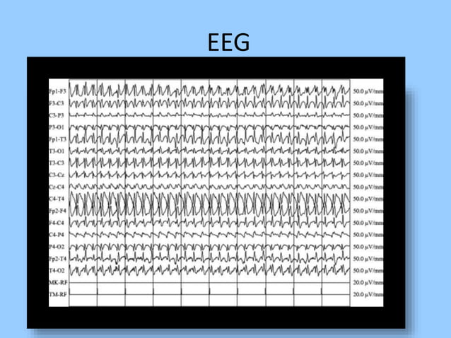 Eeg in pediatric (DNB PEDIATRIC) | PPTX | Brain and Nervous System ...