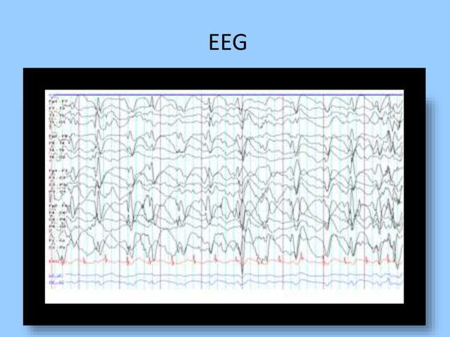 Eeg in pediatric (DNB PEDIATRIC) | PPTX | Brain and Nervous System ...