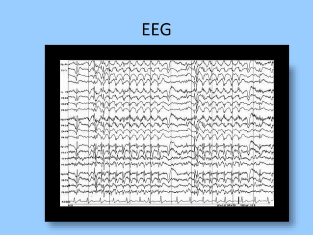Eeg in pediatric (DNB PEDIATRIC) | PPTX | Brain and Nervous System ...