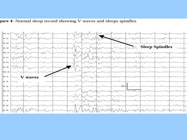 Eeg in pediatric (DNB PEDIATRIC) | PPTX | Brain and Nervous System ...