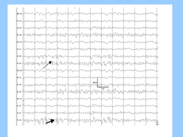 Eeg in pediatric (DNB PEDIATRIC) | PPT